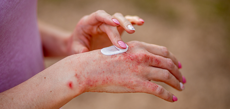 Päivitetty Käypä hoito -suositus: Uusia biologisia lääkkeitä ...