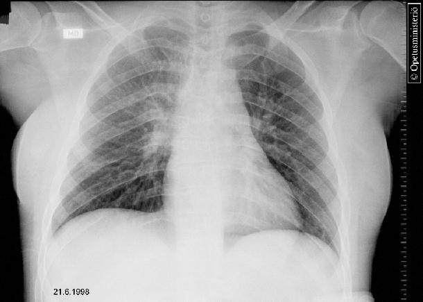 Solisluun mediaalinen murtuma