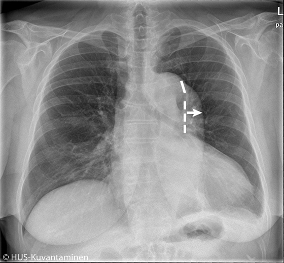Aortan dissekoituma keuhkokuvassa