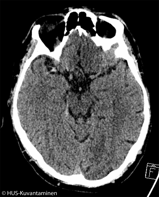 MCA:n tukos pään TT-kuvassa