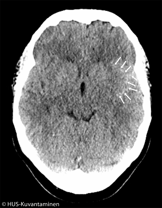 SAV pään TT-kuvassa